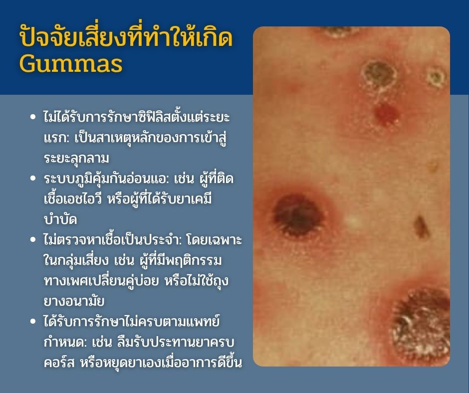 รู้จักกับ Gummas เนื้องอกจากโรคซิฟิลิสระยะลุกลาม | STI CENTER